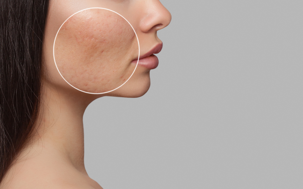 Can Rosacea be Treated Successfully?